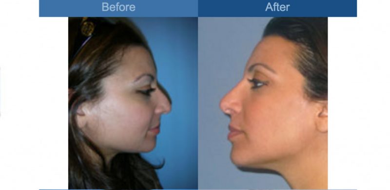 Rhinoplasty Nose Job Surgery | Dr. Stefan Adair